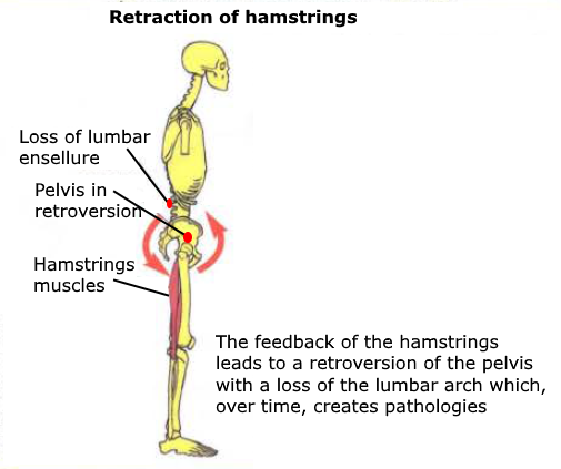 Tear Of Hamstring Muscle • Stephane Andre